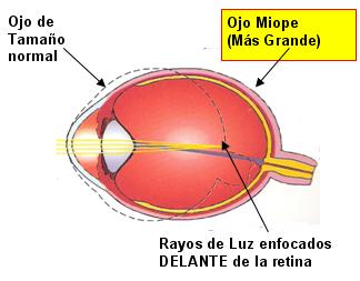 Instructivos Defectos Refractivos - Dr. Luis Fernando Mejía ...